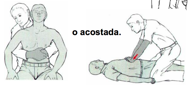 Información que salva: ¿Qué es la maniobra de Heimlich y cómo se aplica?