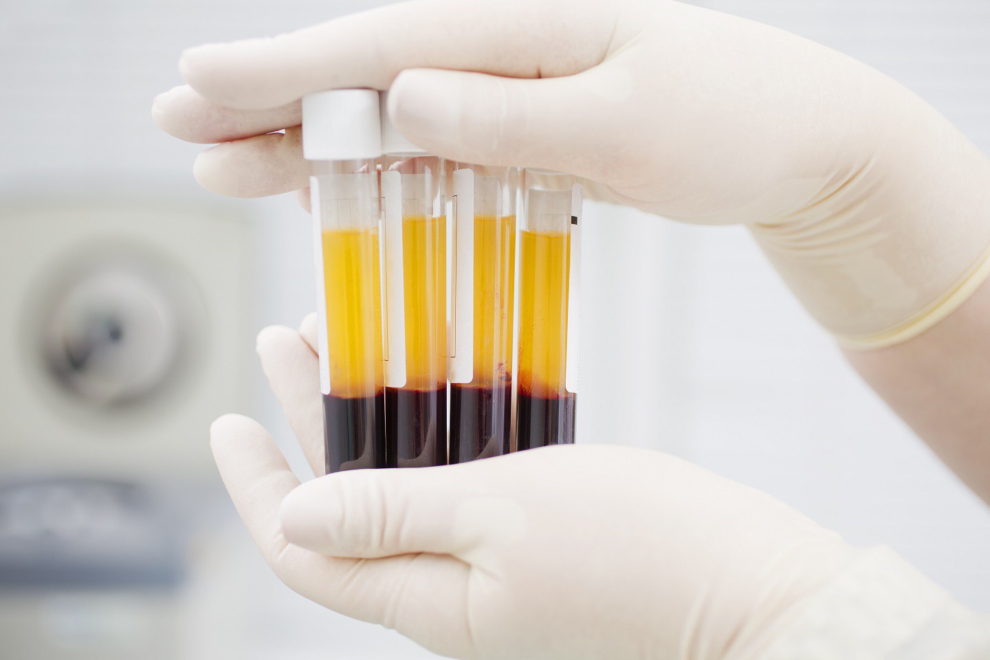 Dona plasma sanguíneo: Para qué sirve y por qué es importante
