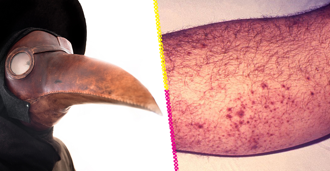 La primera muerte por peste bubónica en años: ¿Qué es y cuáles son los ...