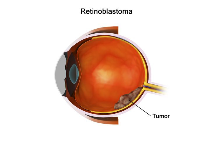 #RetratosQueSalvan: La campaña para detectar el cáncer de ojo a través ...