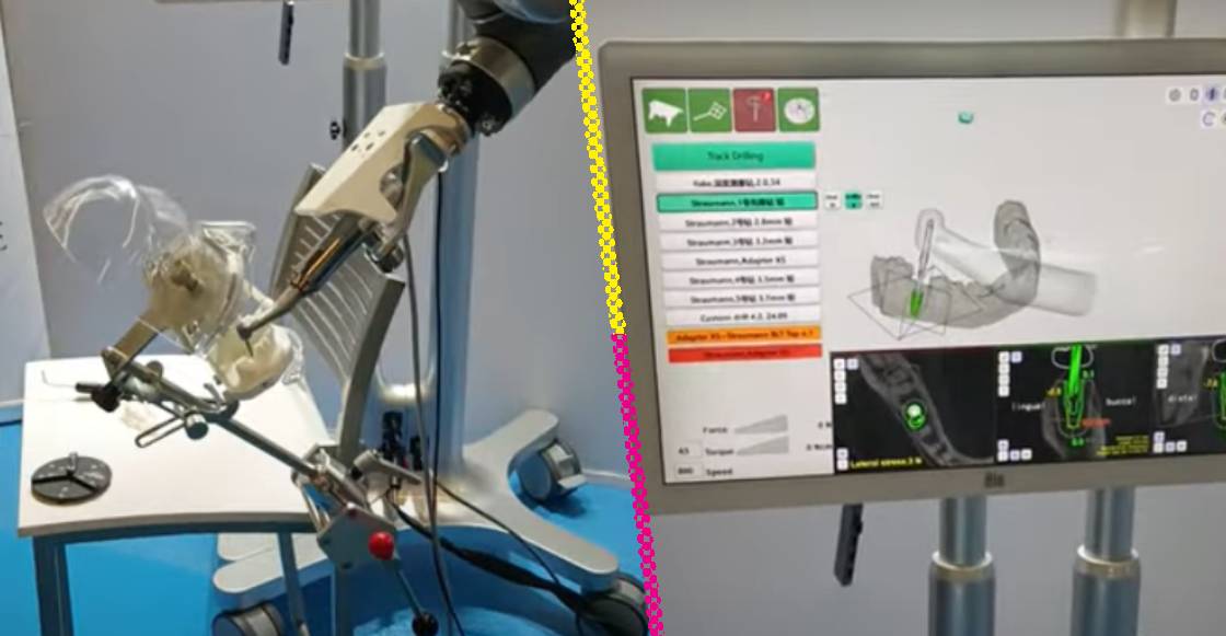 Yakebot, el primer robot dentista que hace cirugías con "precisión ...